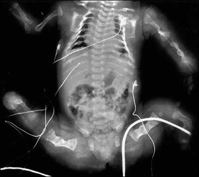 Osteogênese imperfeita | Biosom - Blog